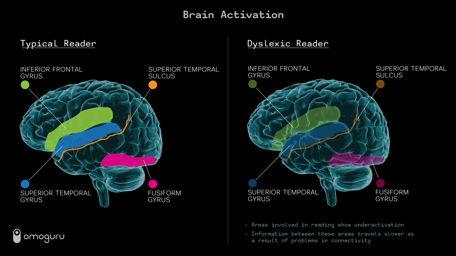 Dyslexia And Reading In The Brain Omoguru Dyslexia And Reading In The Brain Omoguru